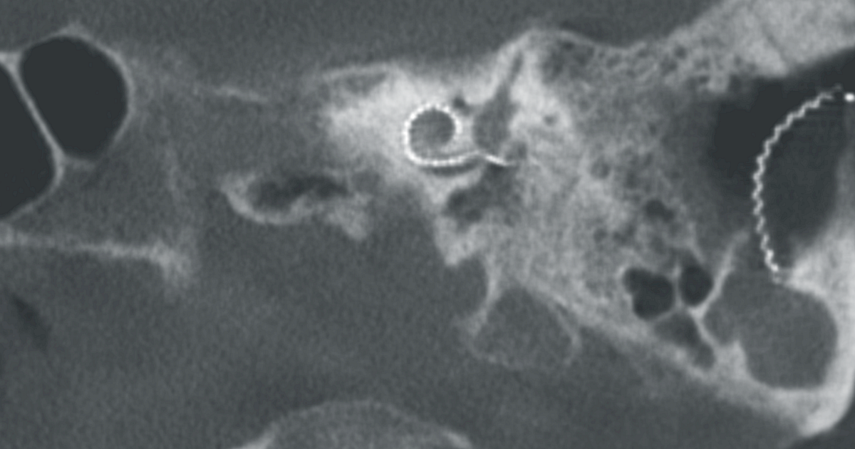 Cochlear implantation and ENT surgery - Ziehm Imaging | EN