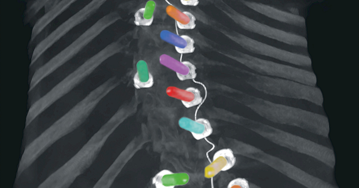 Enhanced Screw Visualization (ESV) - Ziehm Imaging | EN