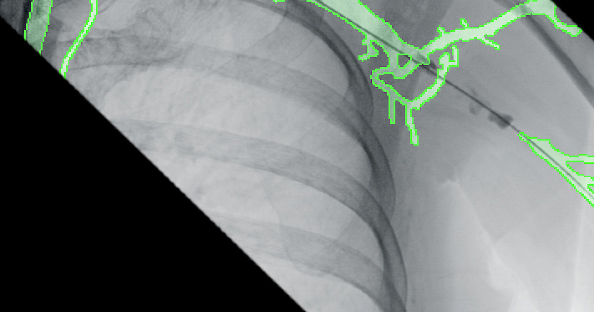 Enhanced Vessel Visualisation (EVV) - Ziehm Imaging | EN